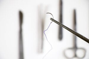 Surgical Staples Vs. Sutures: A Technical Guide To Optimal Wound ...